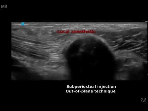 Novel Ultrasonographic image of subperiosteal WALANT injection - YouTube