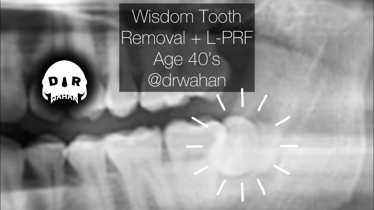 Wisdom Tooth Extraction with Trough and Sectioning and L-PRF Plug ...