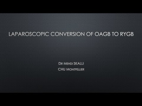 Laparoscopic conversion of OAGB (One-anastomosis Gastric Bypass) to ...