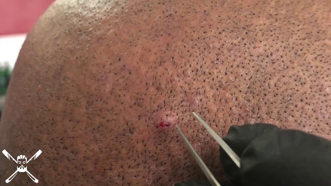Ingrown Hair Extraction - Short Clip - YouTube