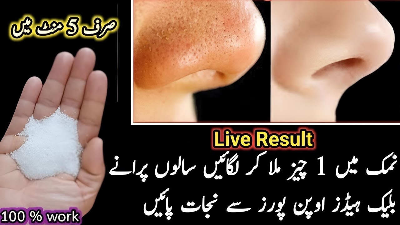 How To Remove Blackheads at Home | In Just 5 Minutes Best Way To Remove ...