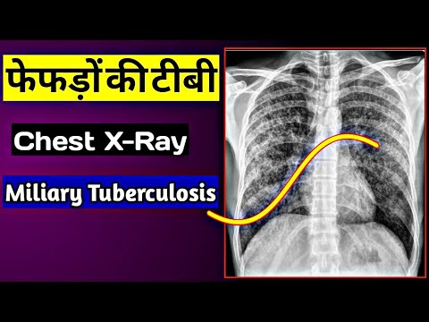 Chest X-Ray Normal vs TB Positive | Miliary Tuberculosis | Uday XRay - YouTube
