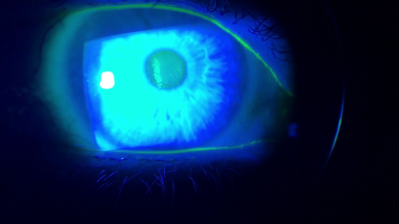 Dry Eye Assessment: Tear Break Up Time - YouTube