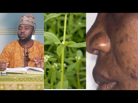 Maganin Kurajen Fuska /Kesbi Sheikh Abbakar Pharmacy