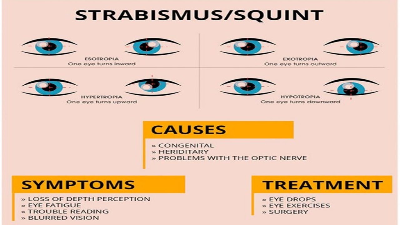 Strabismus || Squint... Part. 1 - YouTube