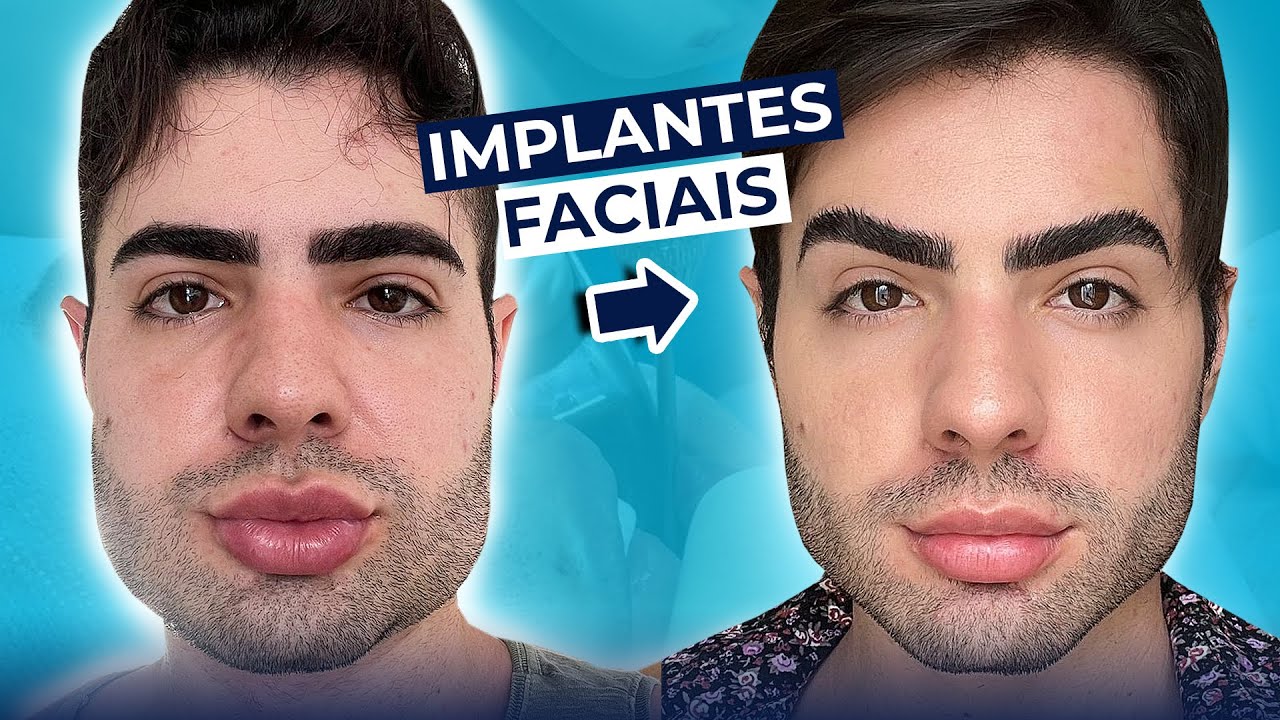 EP 4: EVOLUÇÃO DO IMPLANTE DE MANDÍBULA DEFINITIVO E BICHECTOMIA (1 mês ...