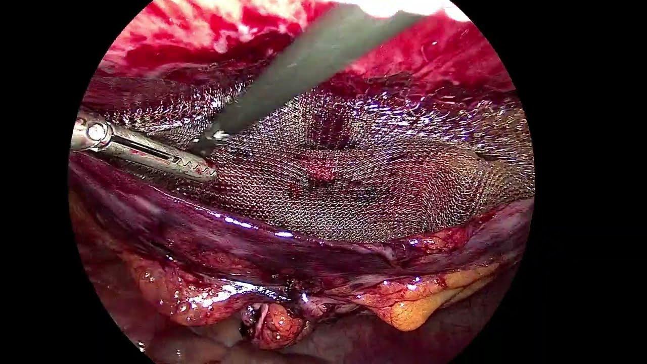 Laparoscopic Trans Abdominal Pre-Peritoneal Ventral hernia repair. Ventral TAPP HD. - YouTube
