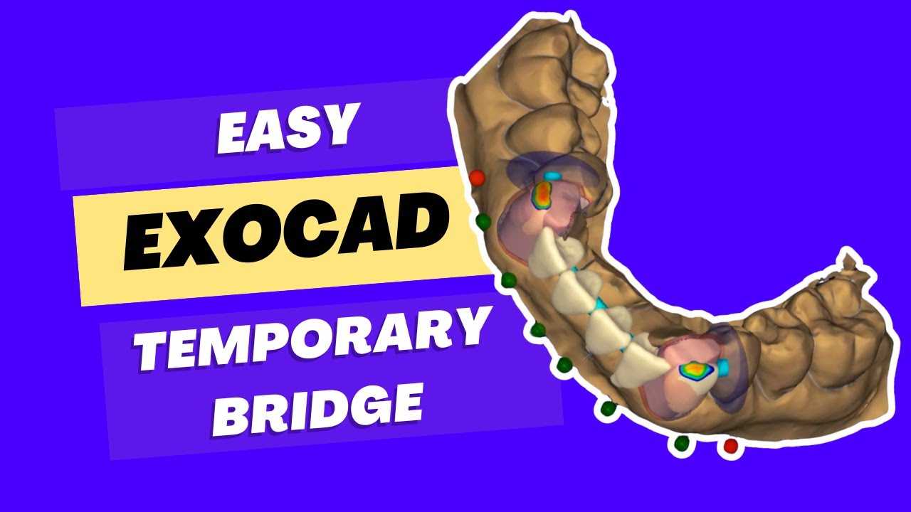 Easy Design a 3D printed Temporary Dental Bridge (Exocad Tutorial ...