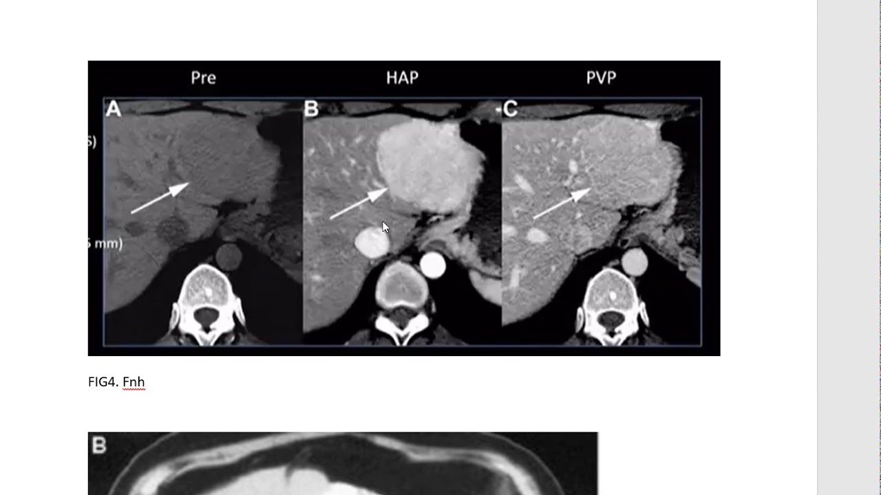 CT scan of hepatic adenoma, ct scan of focal nodular hyperplasia (FNH ...
