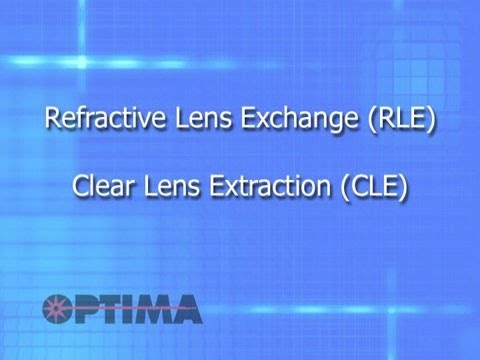 Refractive Lens Exchange RLE – Clear Lens Extraction CLE - YouTube