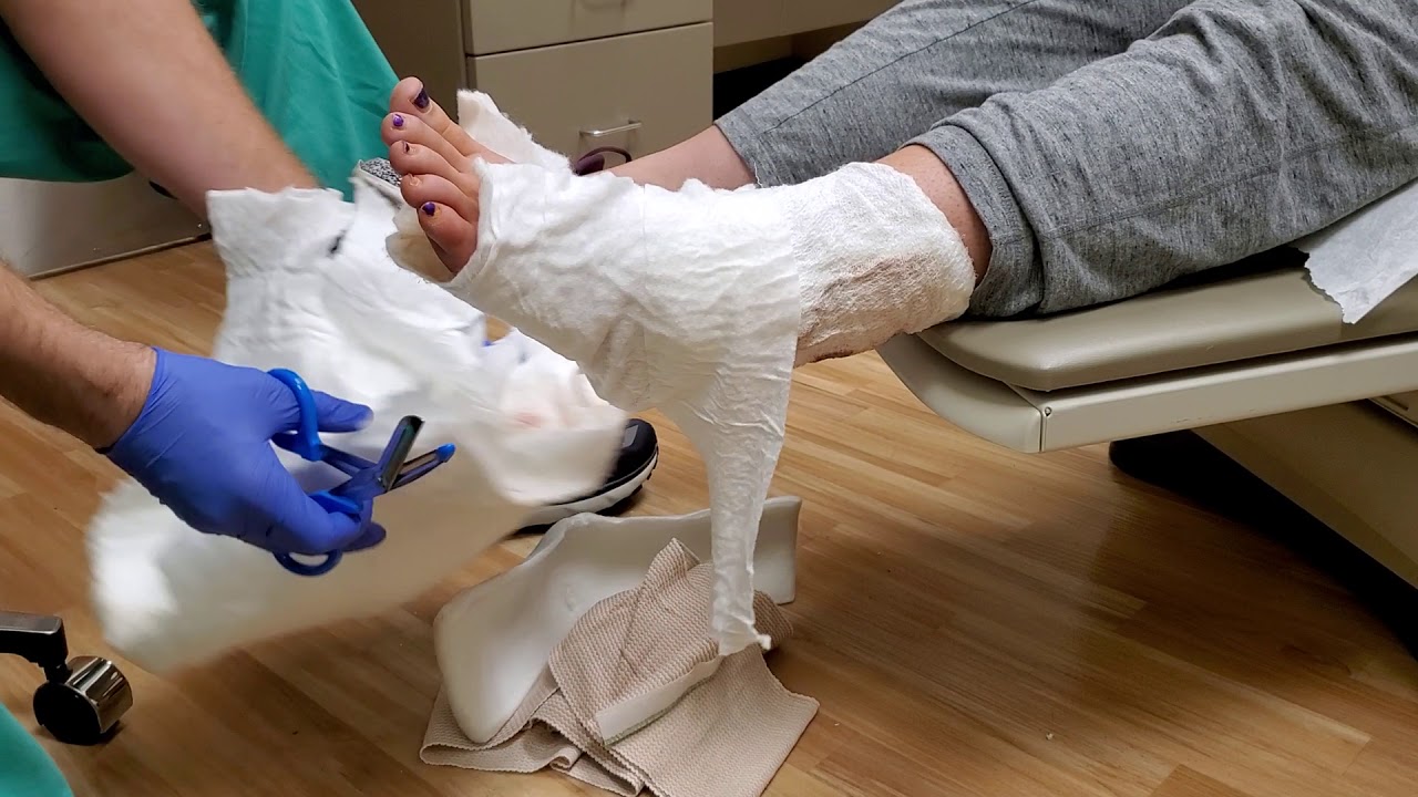Hannah's cast removal - YouTube