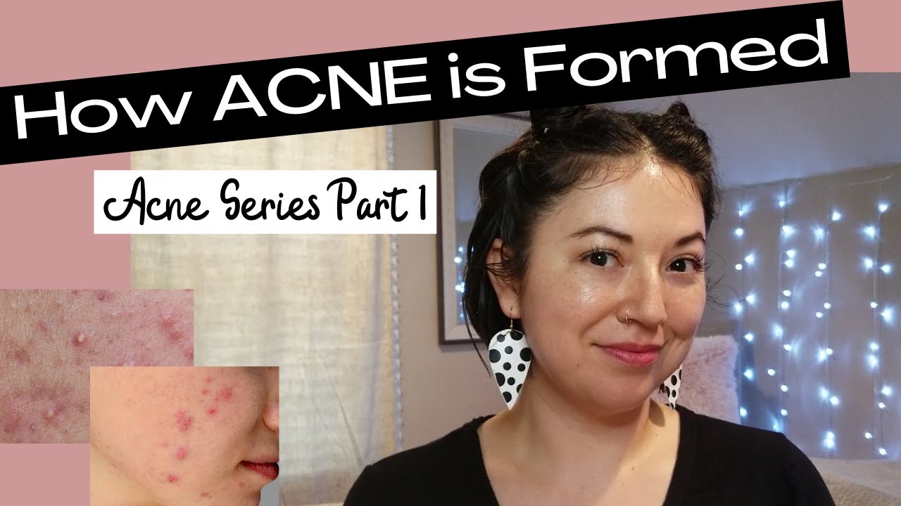 How ACNE is formed - YouTube