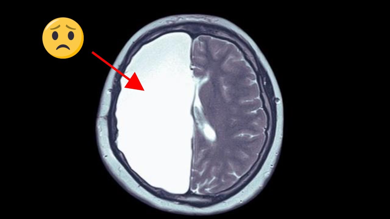 What Happens When We Remove Half of Your Brain? 🧠 Neuroplasticity ...