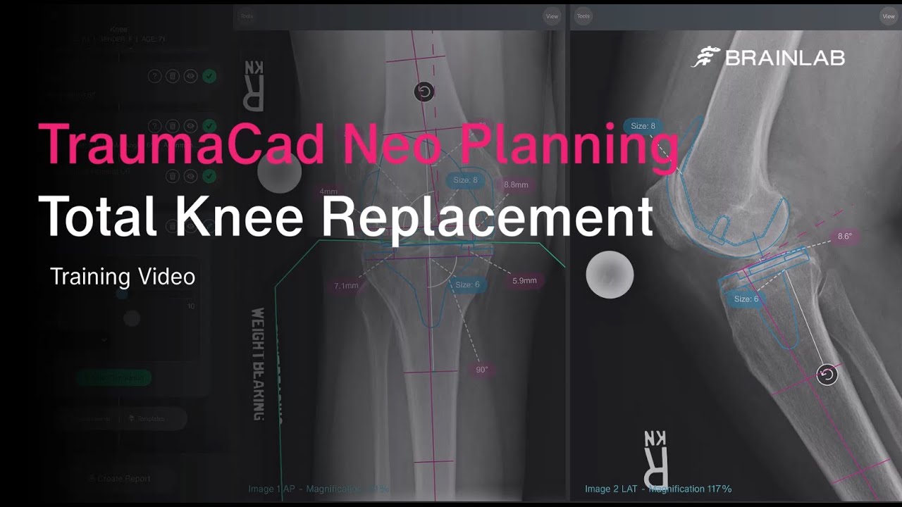 TraumaCad Neo - Knee Tutorial - YouTube