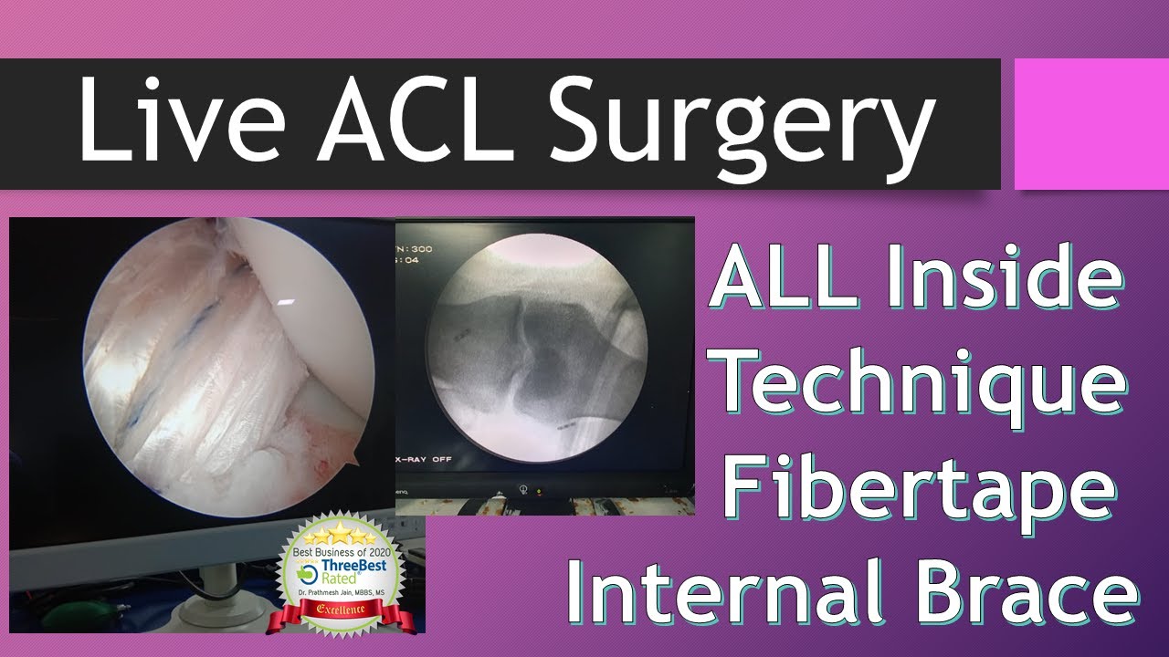ALL Inside ACL Reconstruction with Internal Bracing : Live Surgery ...