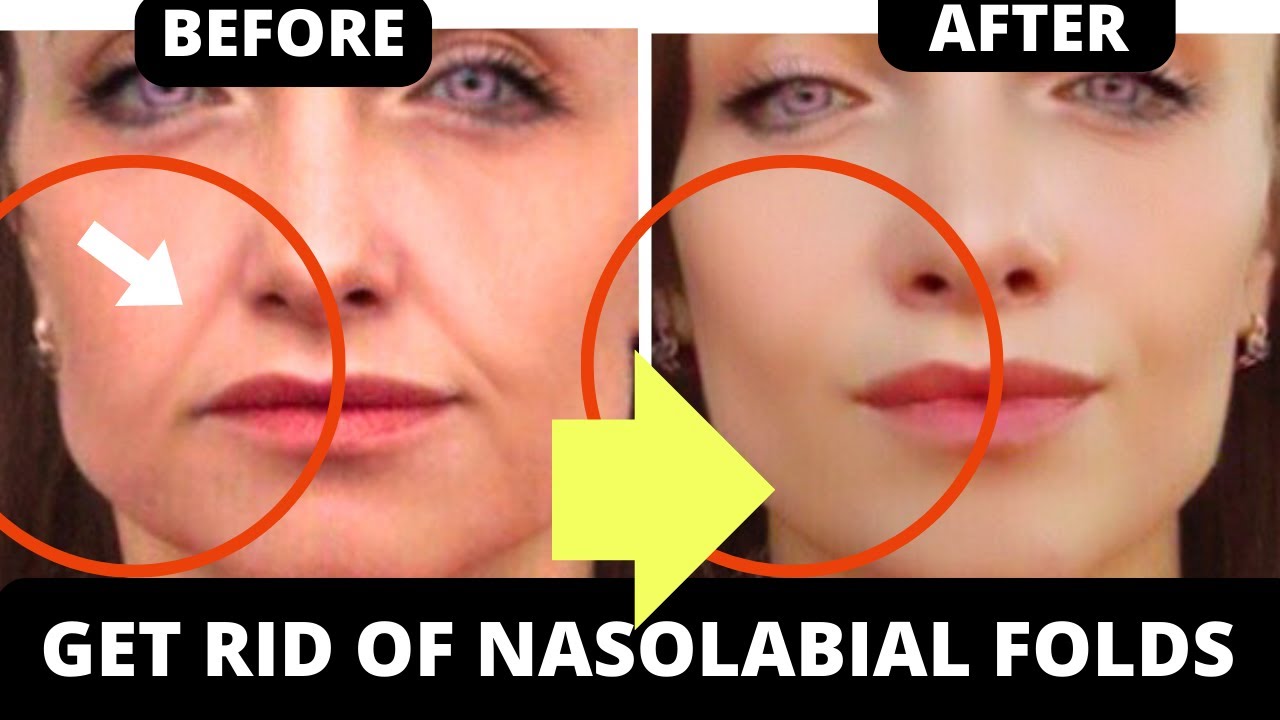 🛑 HOW TO LIFT SMILE LINES ? GET RID OF LAUGH LINES WITH FACE YOGA ...