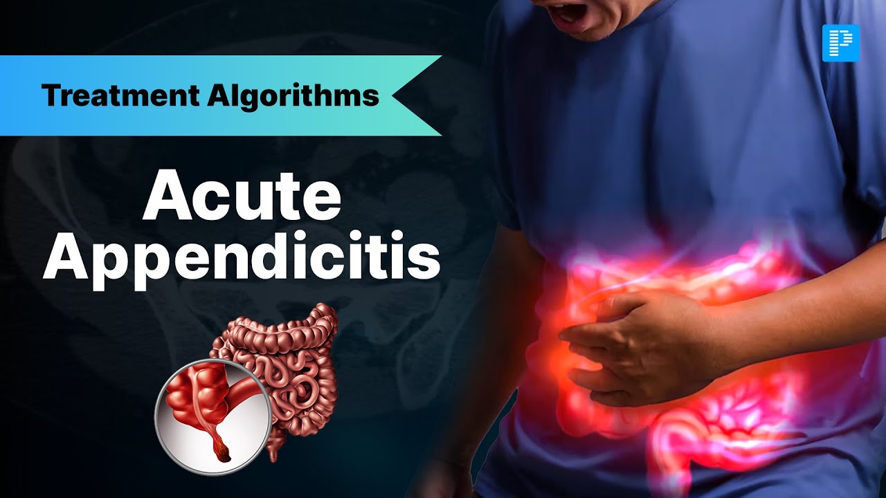 Acute Appendicitis - Signs, Symptoms & Treatment Algorithms - YouTube