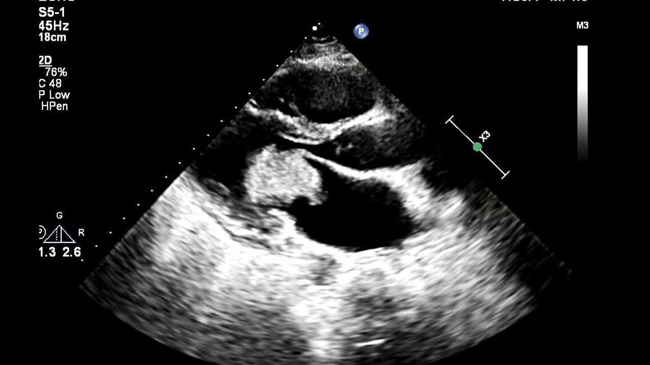 Cardiac Myxoma Revealed by Transthoracic Echocardiography - YouTube