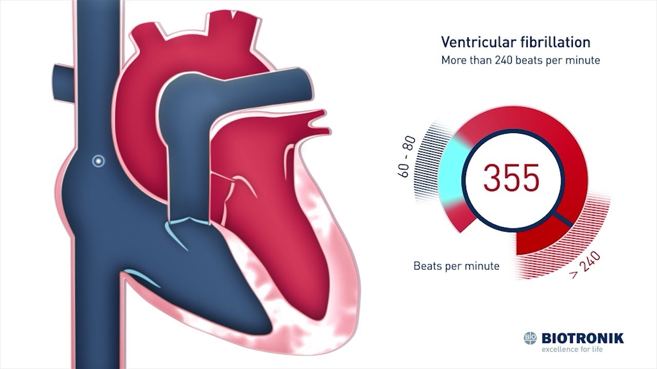 Ventricular Fibrillation, V Fib & Sudden Cardiac Death - YouTube