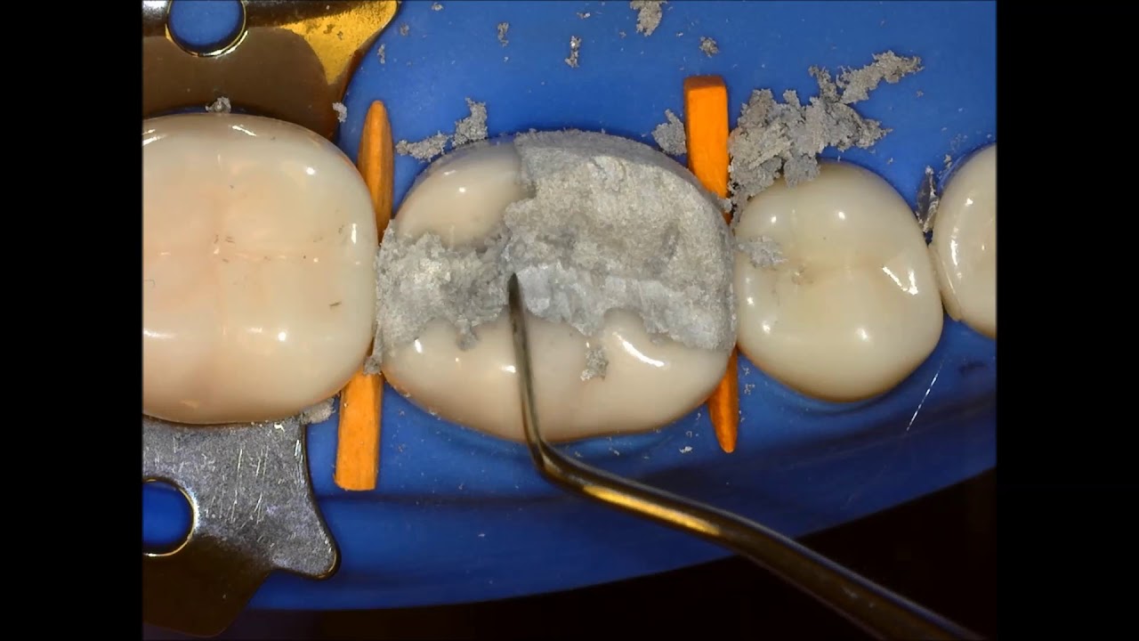 Complex Amalgam Restoration by Dr. Saulo Geraldeli - YouTube