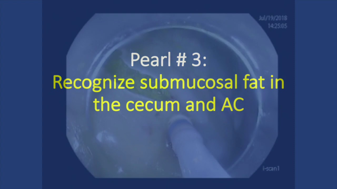Five Pearls of Precut EMR Technique in the Cecum - YouTube