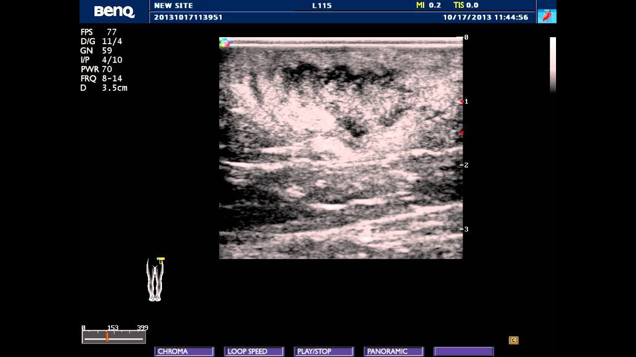 34F, right buttock swelling and redness for one week - YouTube