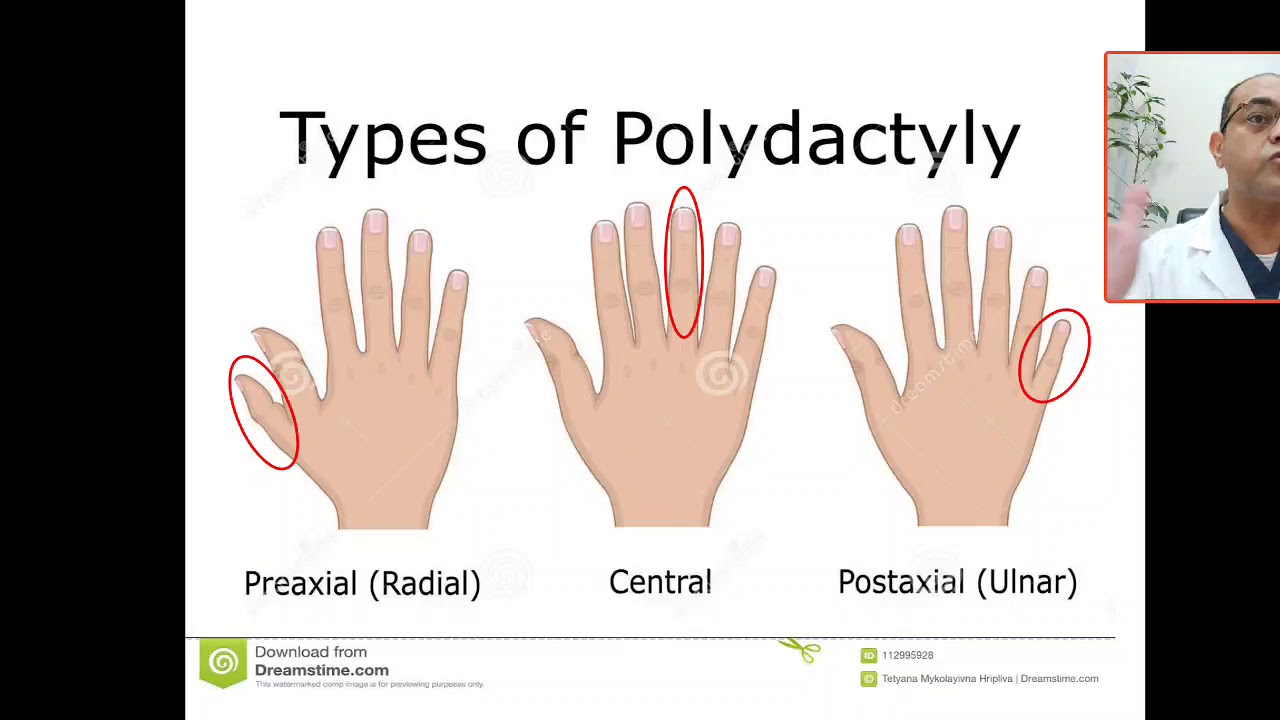 what's polydactaly?sporadic cause, postaxial common type, excision the ...