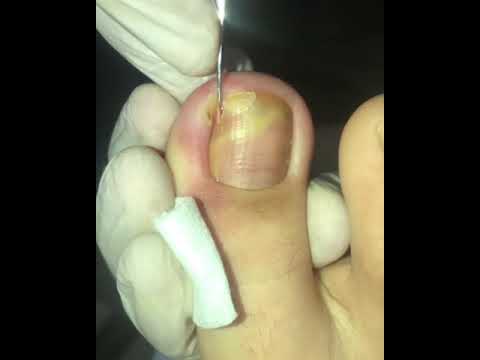 UNHA ENCRAVADA E INFLAMADA 🔴 CURSO DE PODOLOGIA ONLINE - YouTube