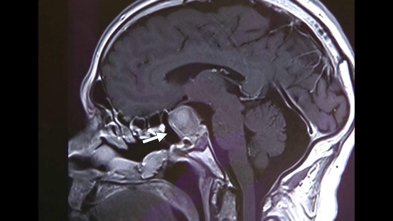 Neurochirurgie Live, Hypophysenadenom, Resektion über frontobasalen ...