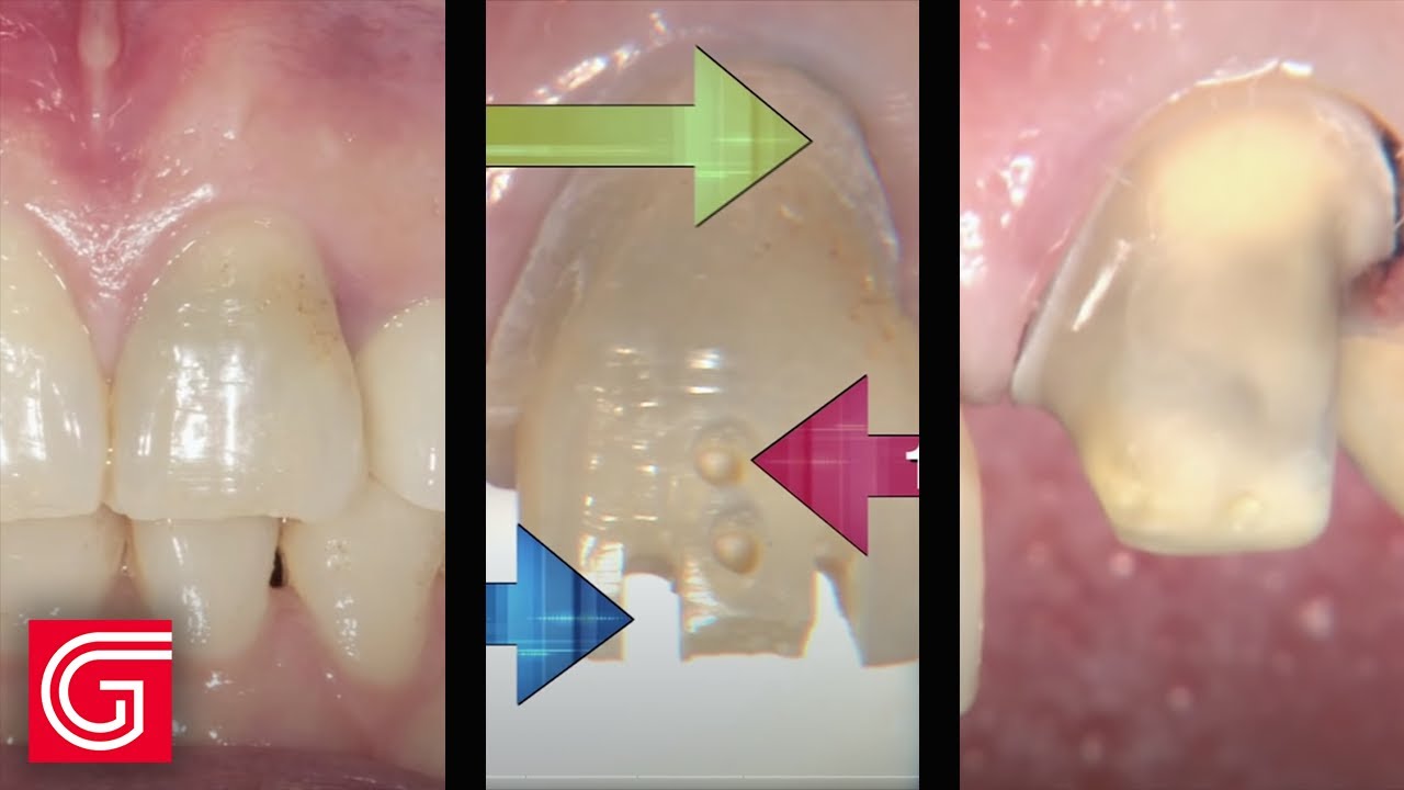 HOW TO Prepare Anterior Teeth Using a Reverse Preparation Technique ...