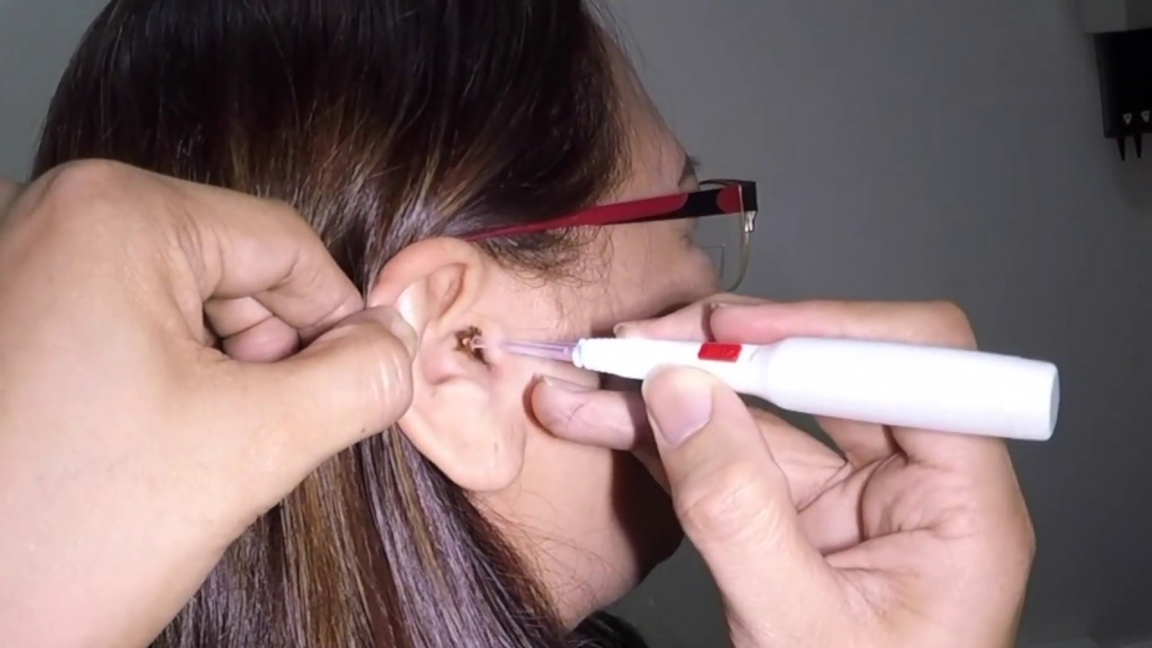 Woman's Earwax Removed from Her Left & Right Ears - YouTube