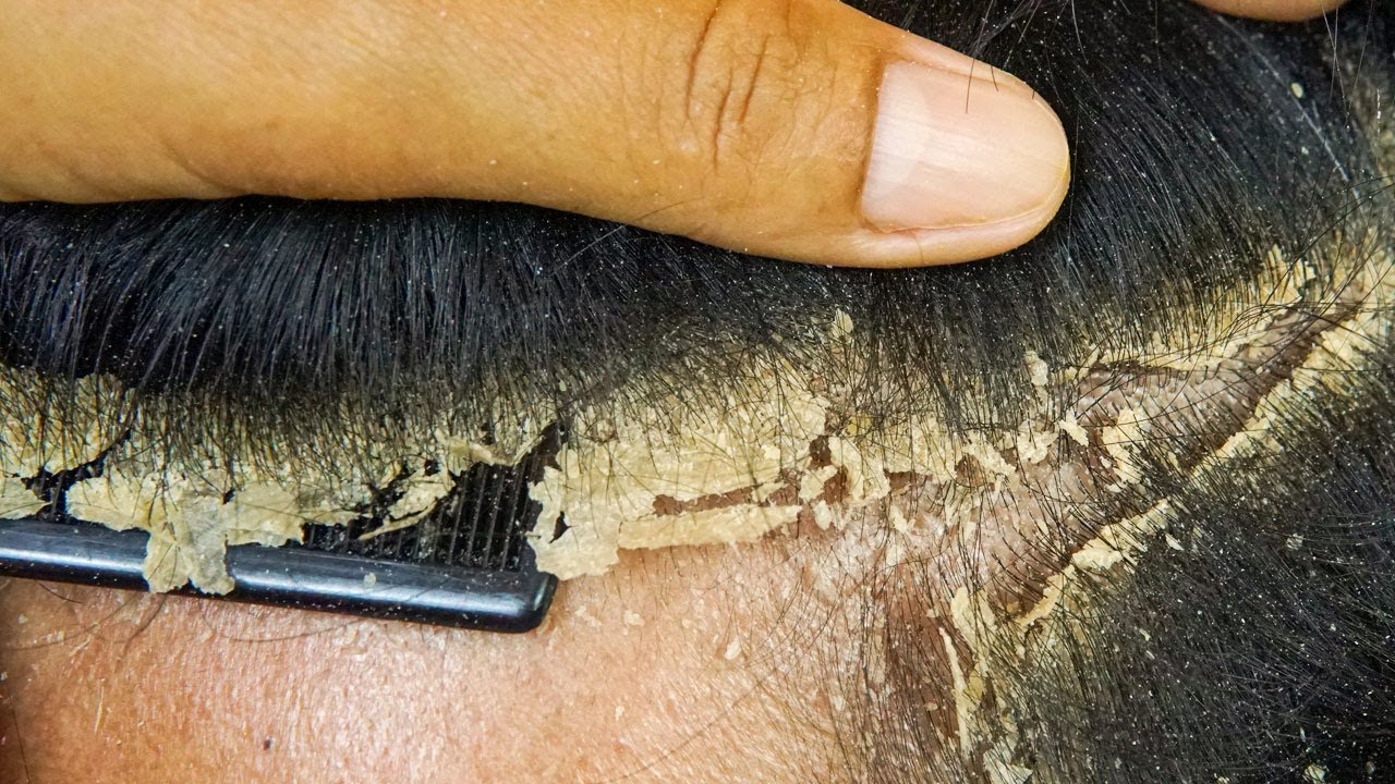 Combing And Scratching Dandruff Off Scalp Part 1 1175 Youtube