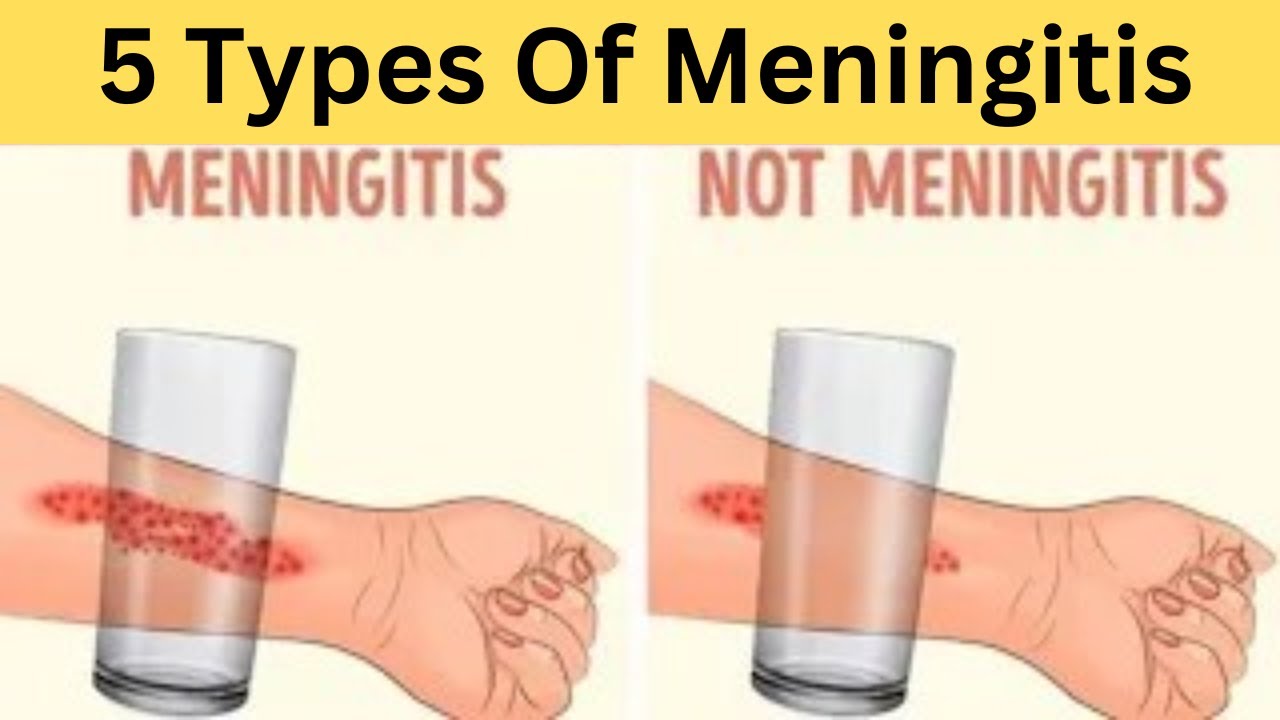 Meningitis Symptoms | Causes of Meningitis - YouTube