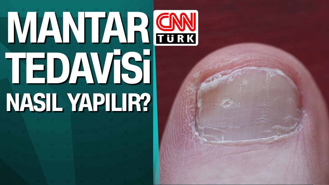 Mantar tedavisi nasıl yapılır? - YouTube