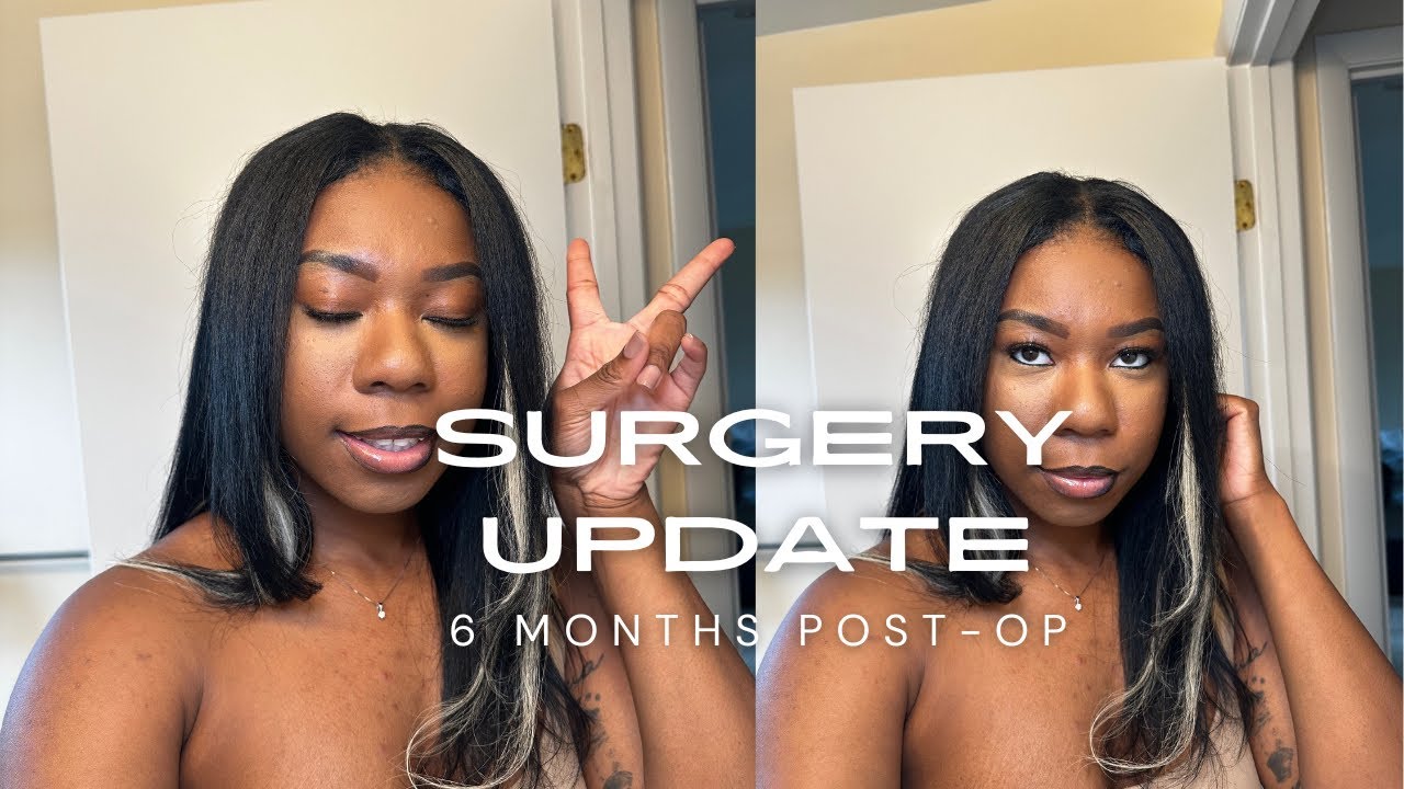 AM I HAPPY WITH MY RESULTS? | MORE SURGERY? | 6 MONTHS POSTOP ...