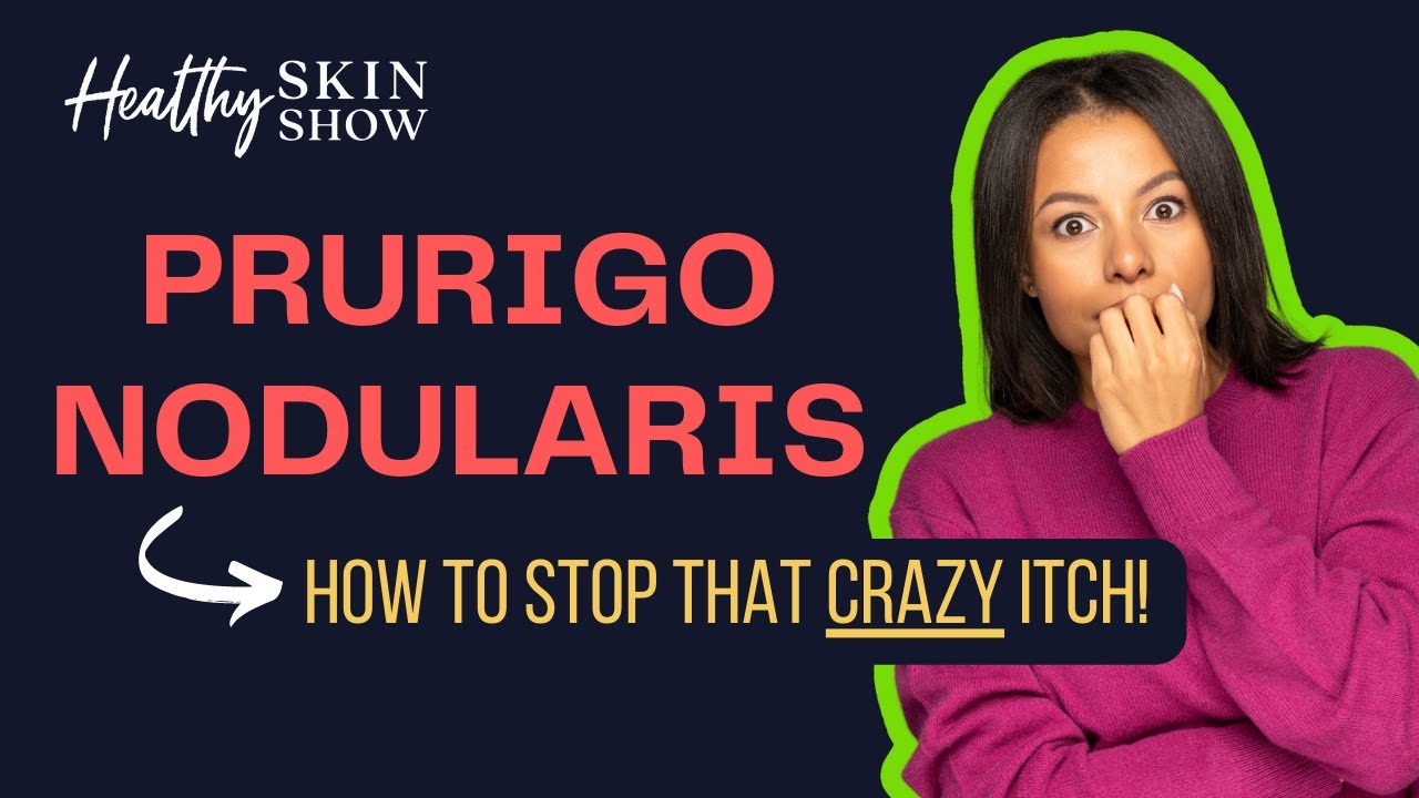 What is PRURIGO NODULARIS: Treatment to STOP the CRAZY ITCH | Shawn ...