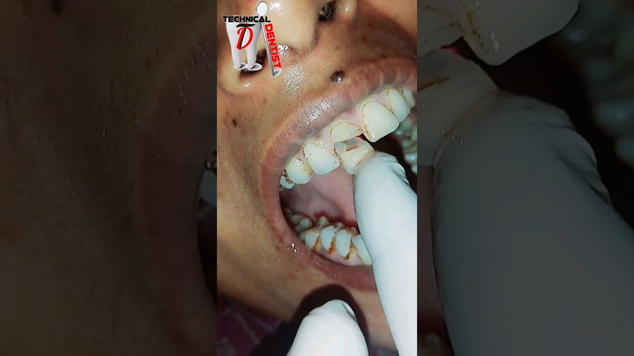 Front teeth RCT with Capping | Central crown cracked - YouTube