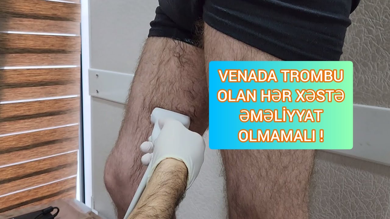vena venoz varikoz damar tromb tromblasma tromboflebit flebotromboz ...