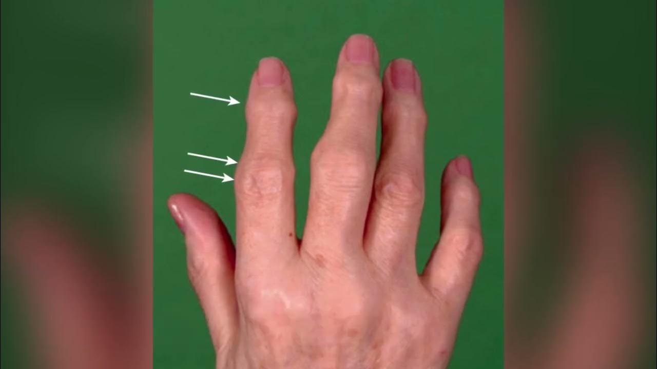 HEBERDEN’S NODES - YouTube