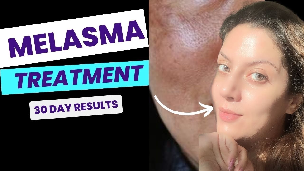 How to remove Melasma at home | Visible results in 30 days | Full AM PM ...