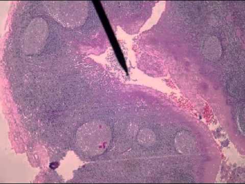 Patologia facil - Amigdala palatina (Amigdalitis cronica) - YouTube