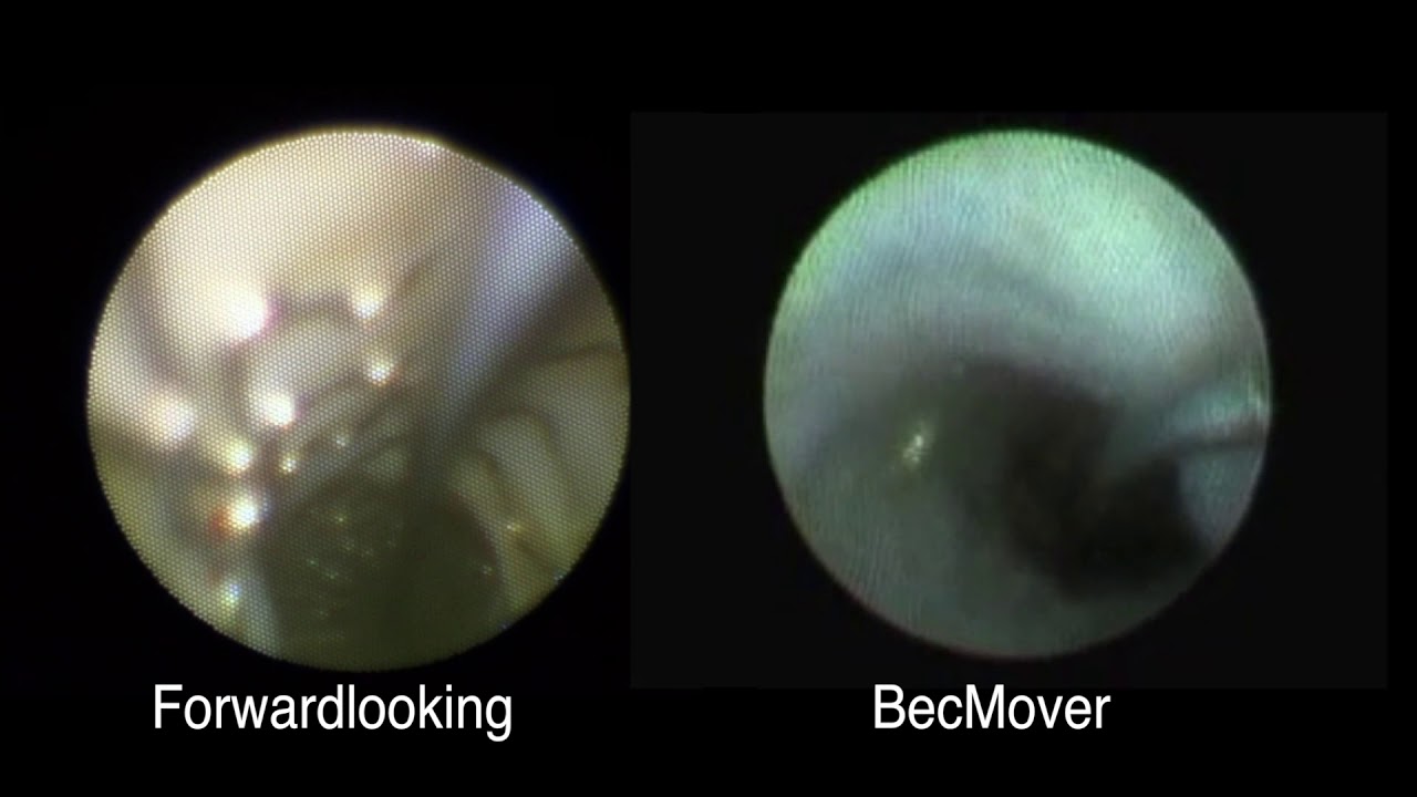 Angioplasty technique: Image quality of a coronary angioscopy. - YouTube