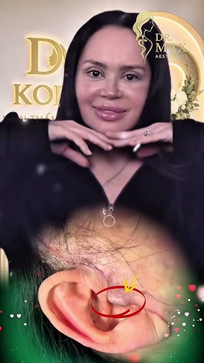 Căng da smas - YouTube