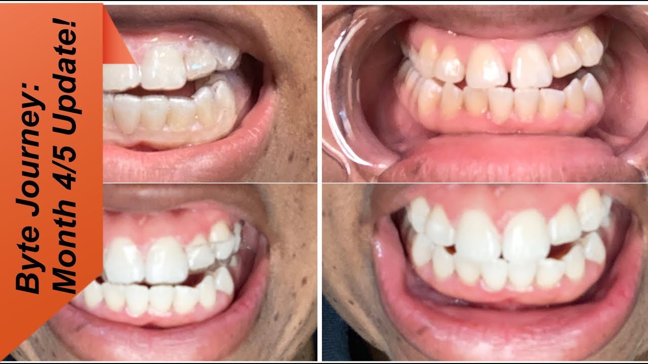 BYTE ALIGNERS: MONTH 4/5 UPDATE | Ben and Cin - YouTube