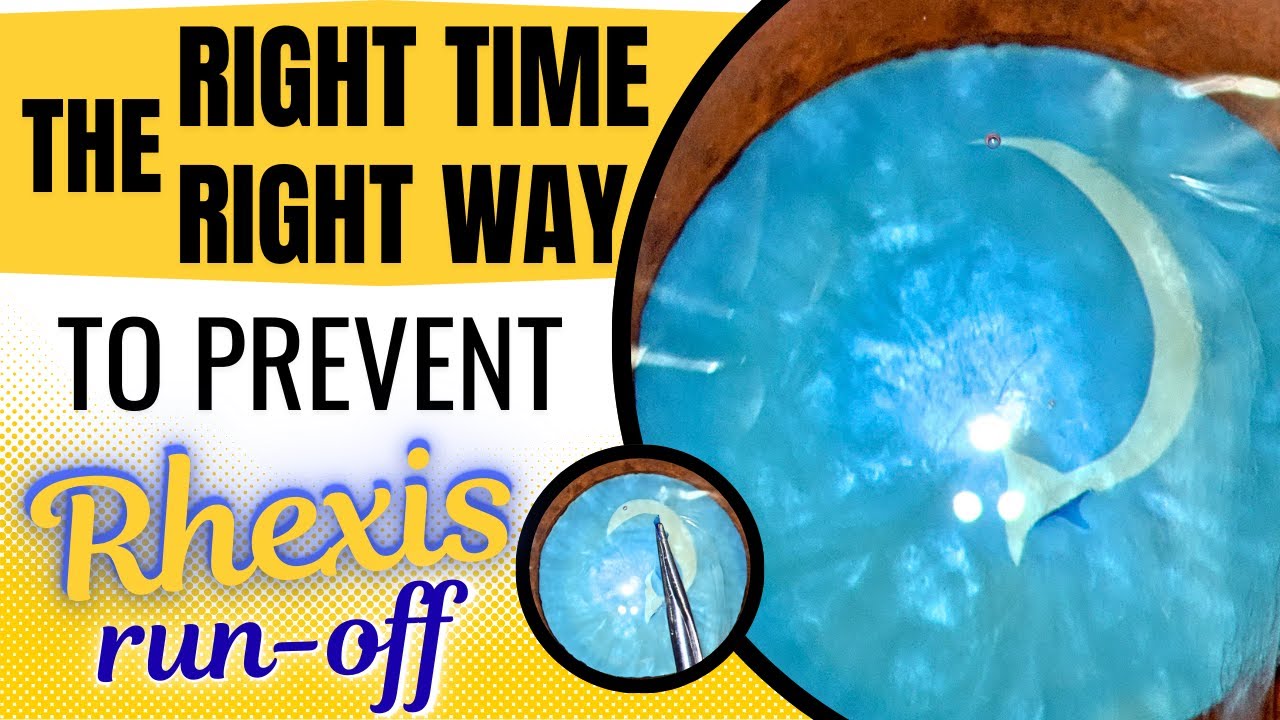 The right time and right ways to prevent rhexis run-off: Dr. Deepak ...