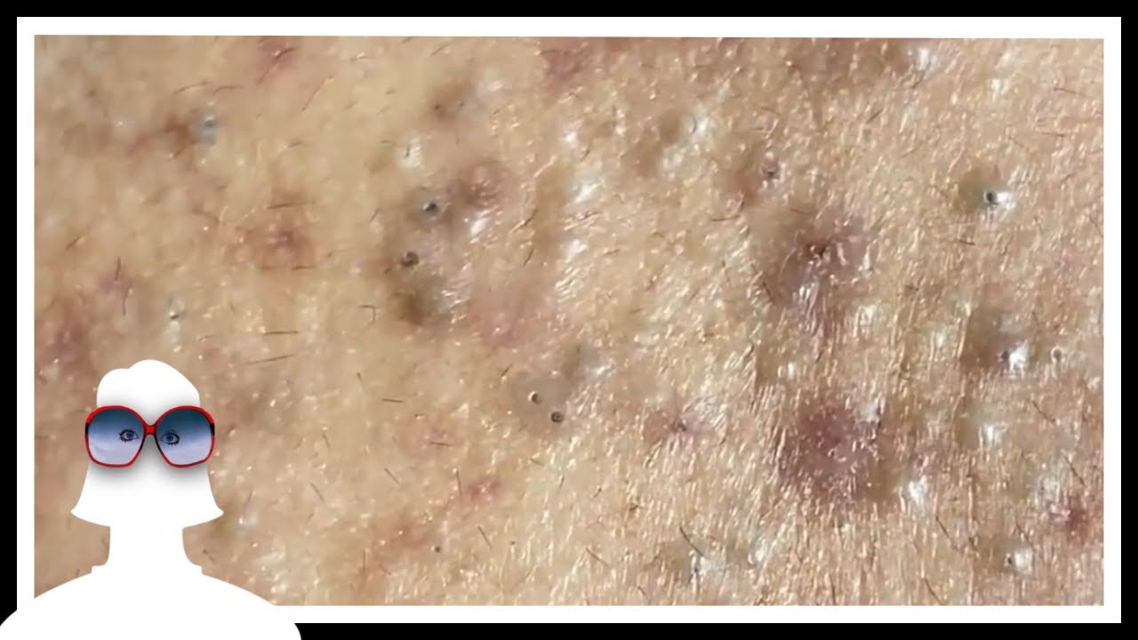 This Week In PIMPLE POPPING! #35 - YouTube