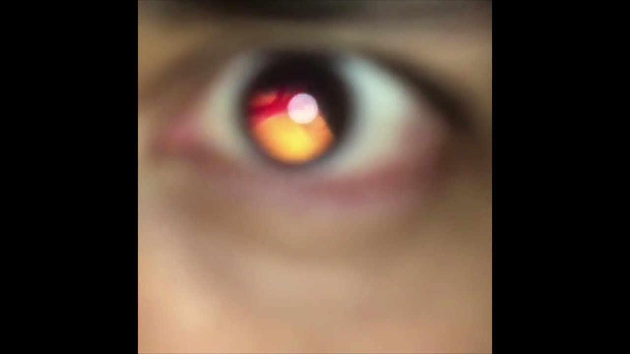 Smartphone Direct Ophthalmoscopy Image - YouTube