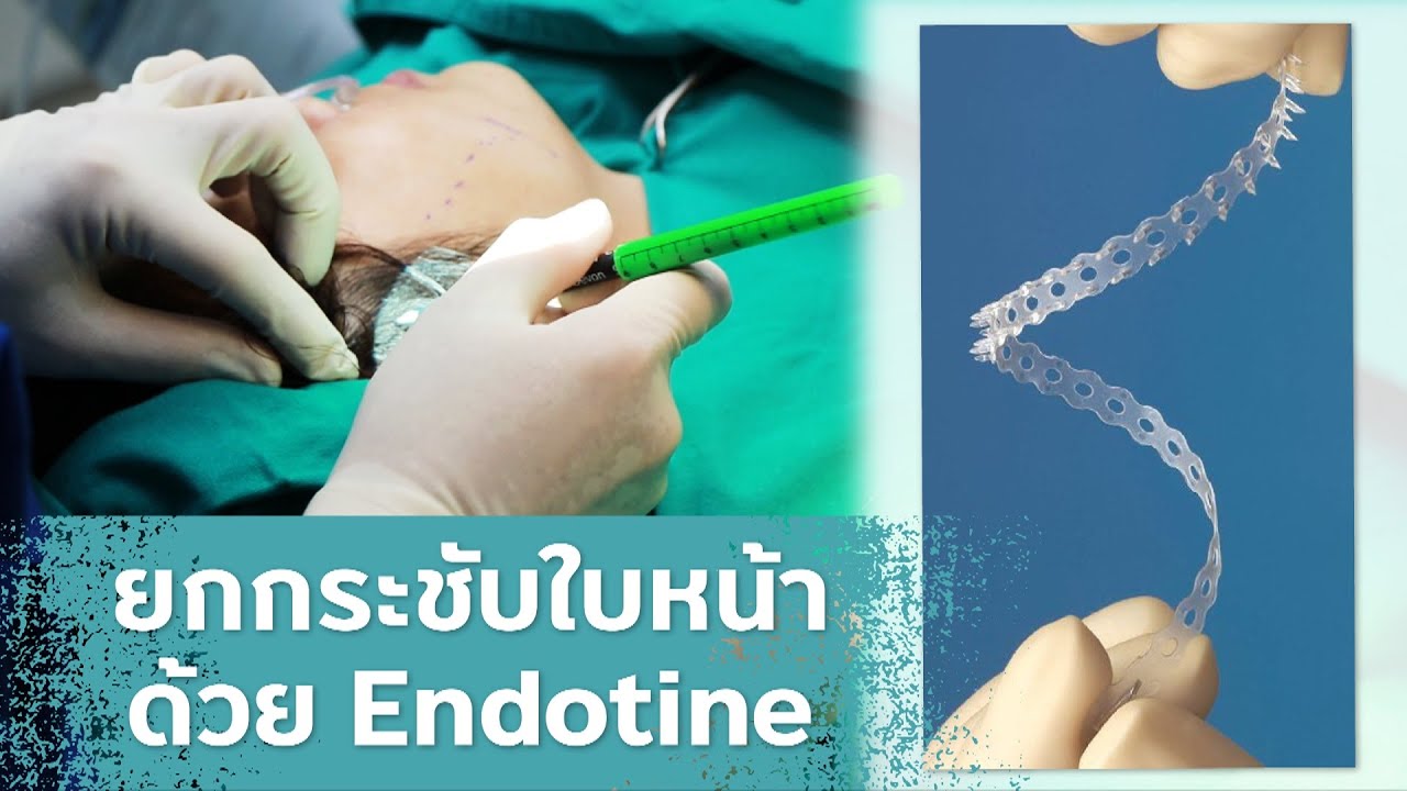 Facelift ดึงหน้าลดอายุ ยกกระชับใบหน้าด้วย Endotine - YouTube
