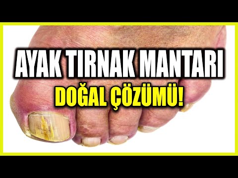 Tırnak Mantarı ile Savaşmanın En Etkili Yolu Budur!