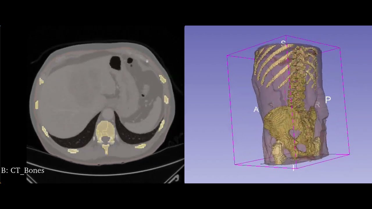 CT Bones Segmentation Exploration - YouTube